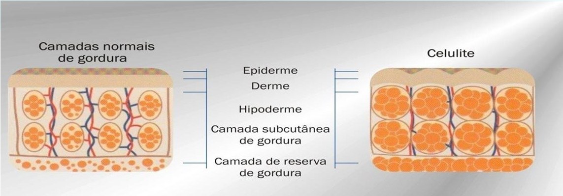 Saiba Tudo sobre CELULITE (FEG) :: Estetika Karina Requena